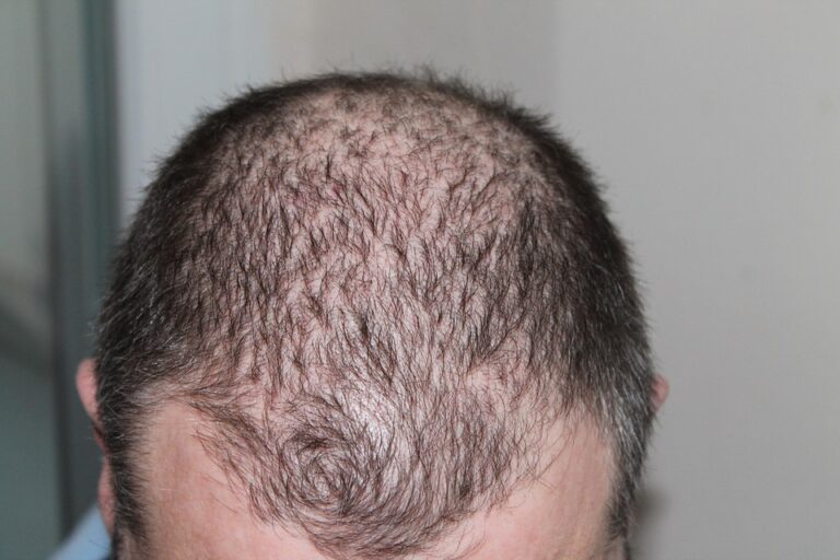 Hair Fall! Causes, Symptoms, treatment - HealthPhit